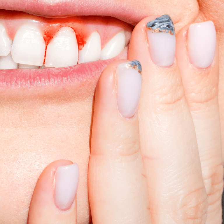 Gum Disease 101: Understanding, Preventing, and Treating - Perfect A ...