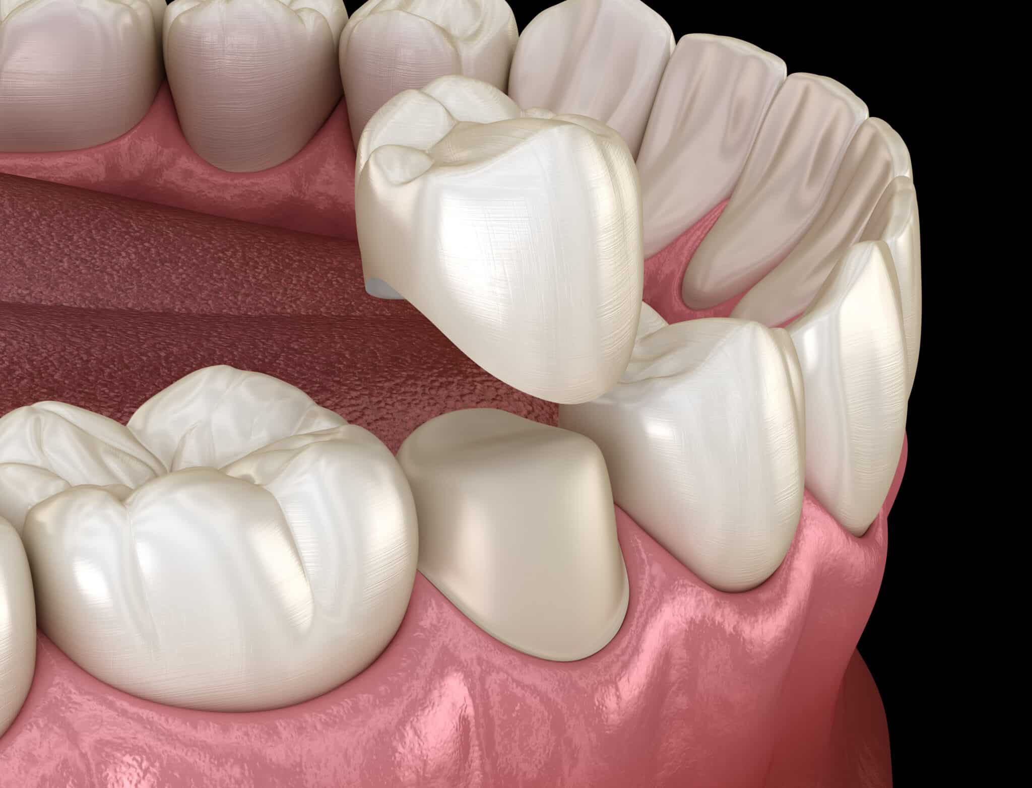 Understanding Dental Crowns and Bridges: When Are They Necessary? - Perfect A Smile Dental Group